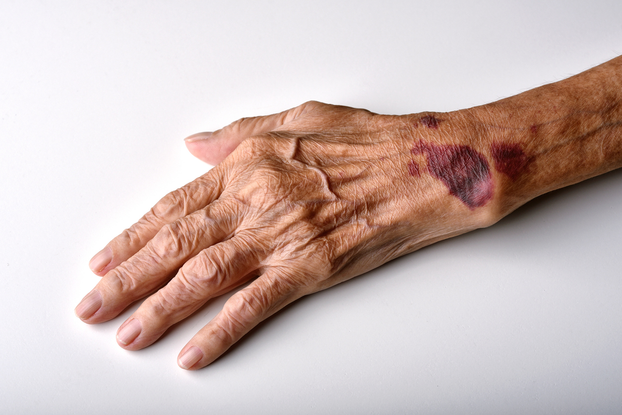 Soft Tissue Injury - WGK Personal Injury Lawyers